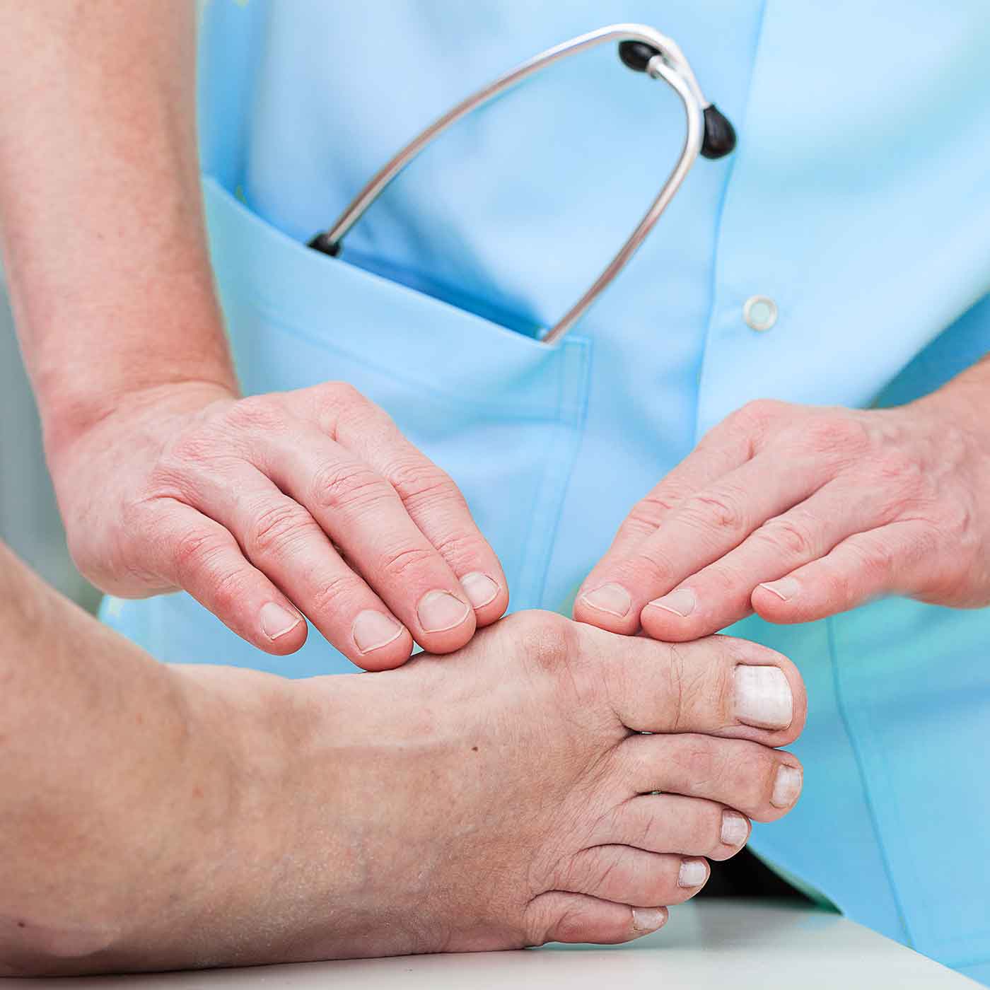 How Do You Treat Bunions?