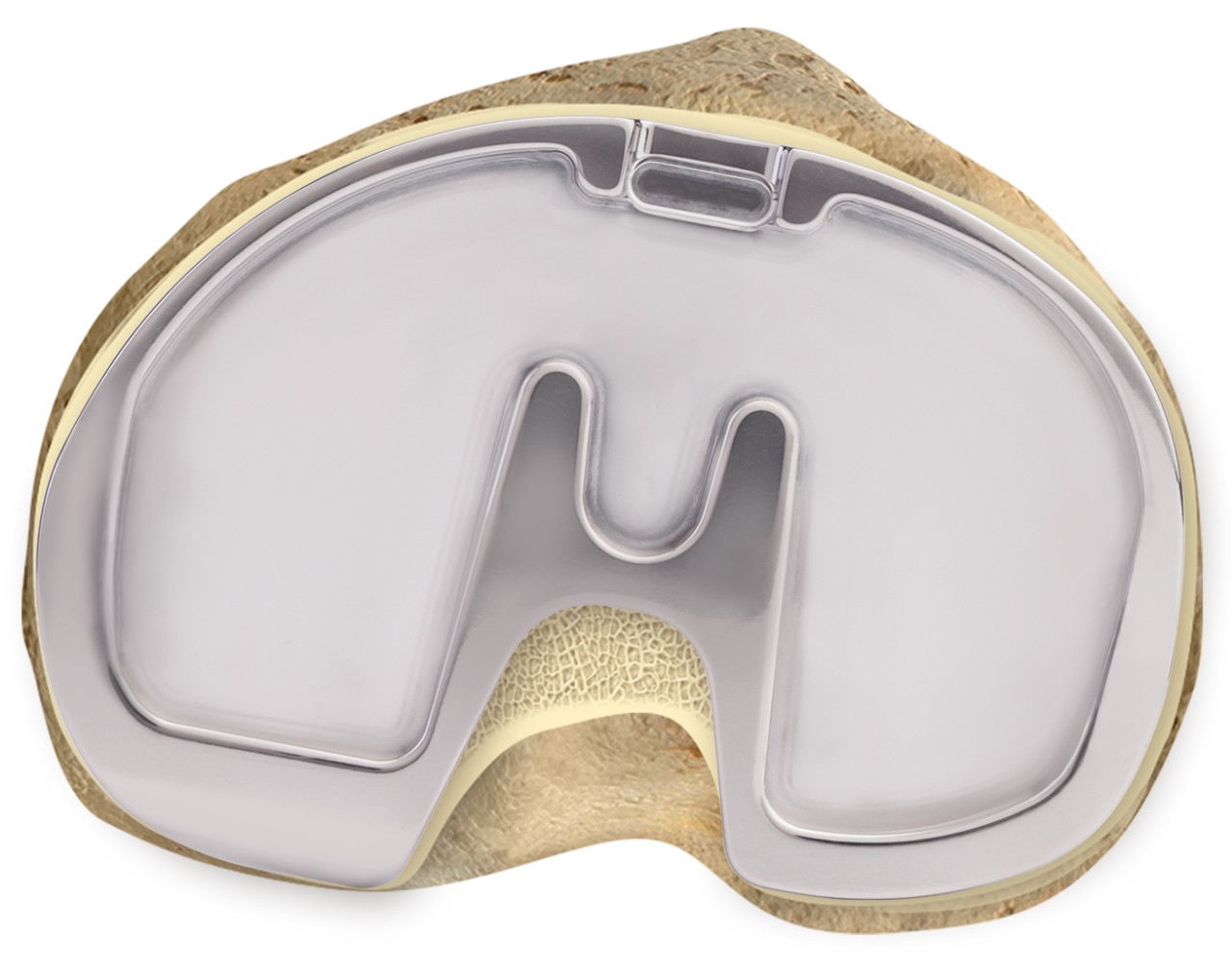 Knee Implant Size and Shape – Do They Matter?