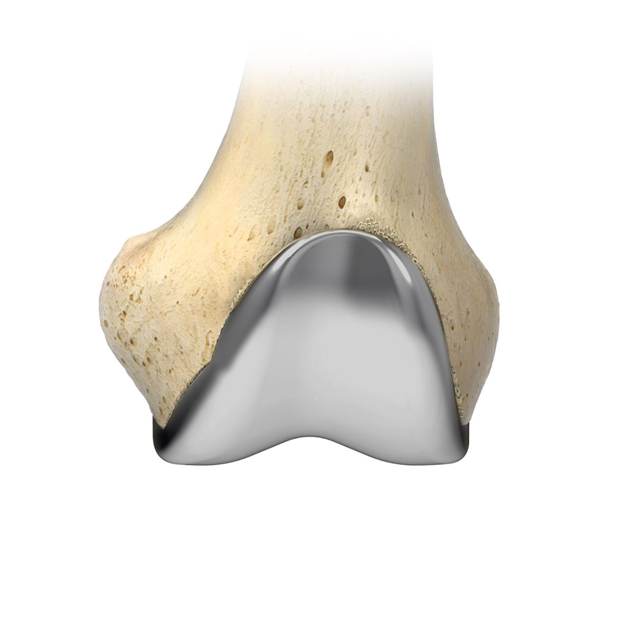 Knee Implant Size and Shape – Do They Matter?