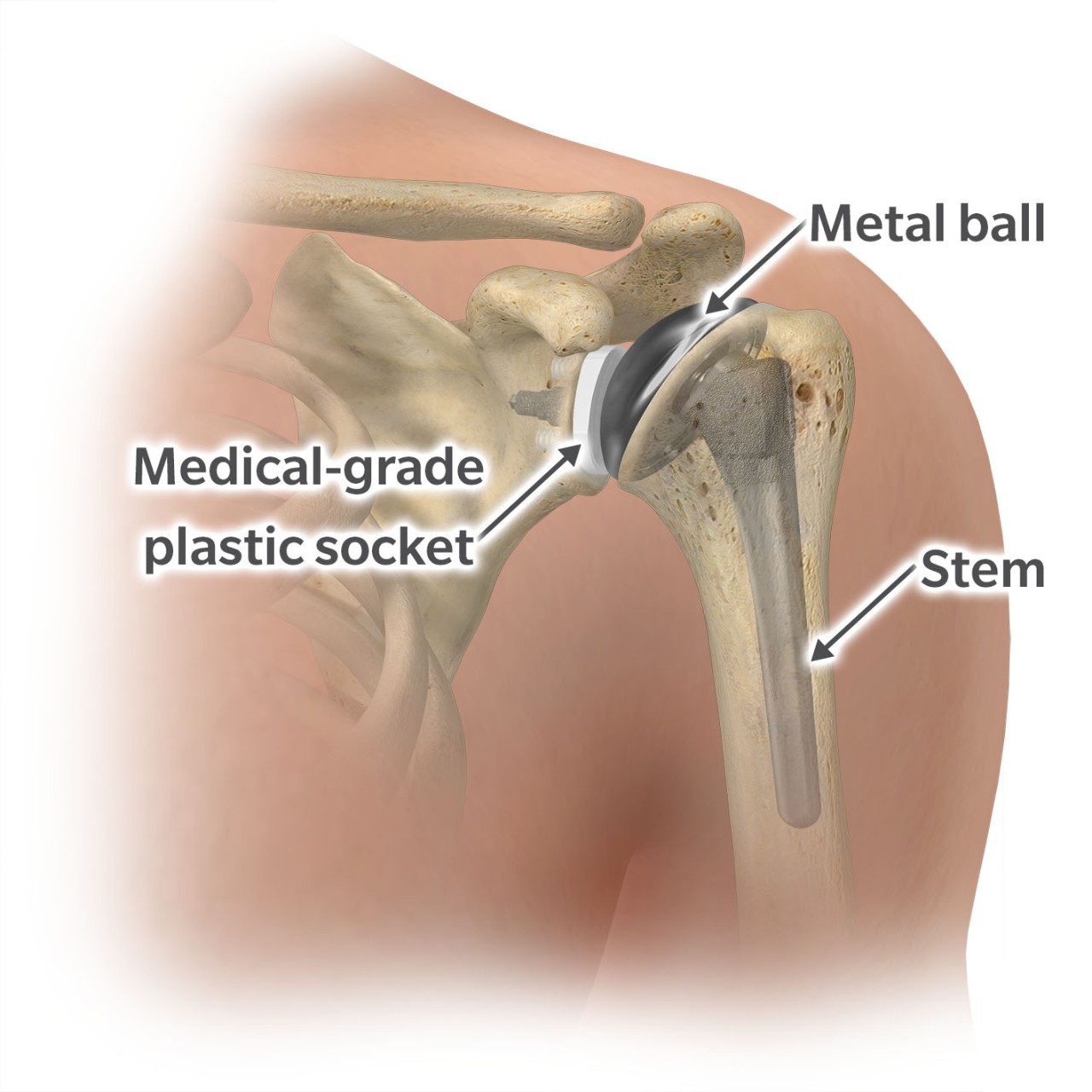 Stemmed Vs Stemless Shoulder Replacement ReadyPatient